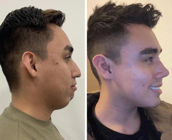 15 People Who Chose Plastic Surgery and Couldn’t Be Happier with Their ...