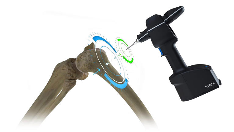 SMH physicians use hand-held robots for knee replacement surgeries