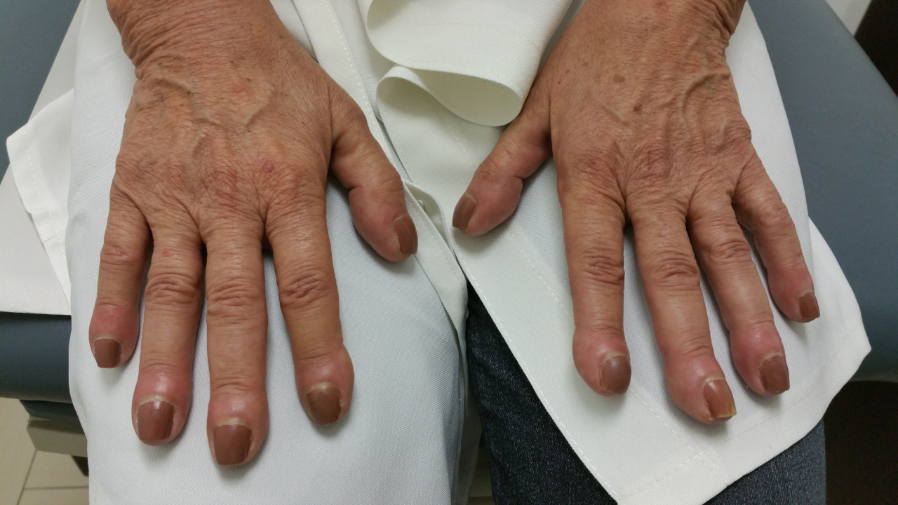 What Is Nail Clubbing, and Could It Be a Sign of a Serious Disease?