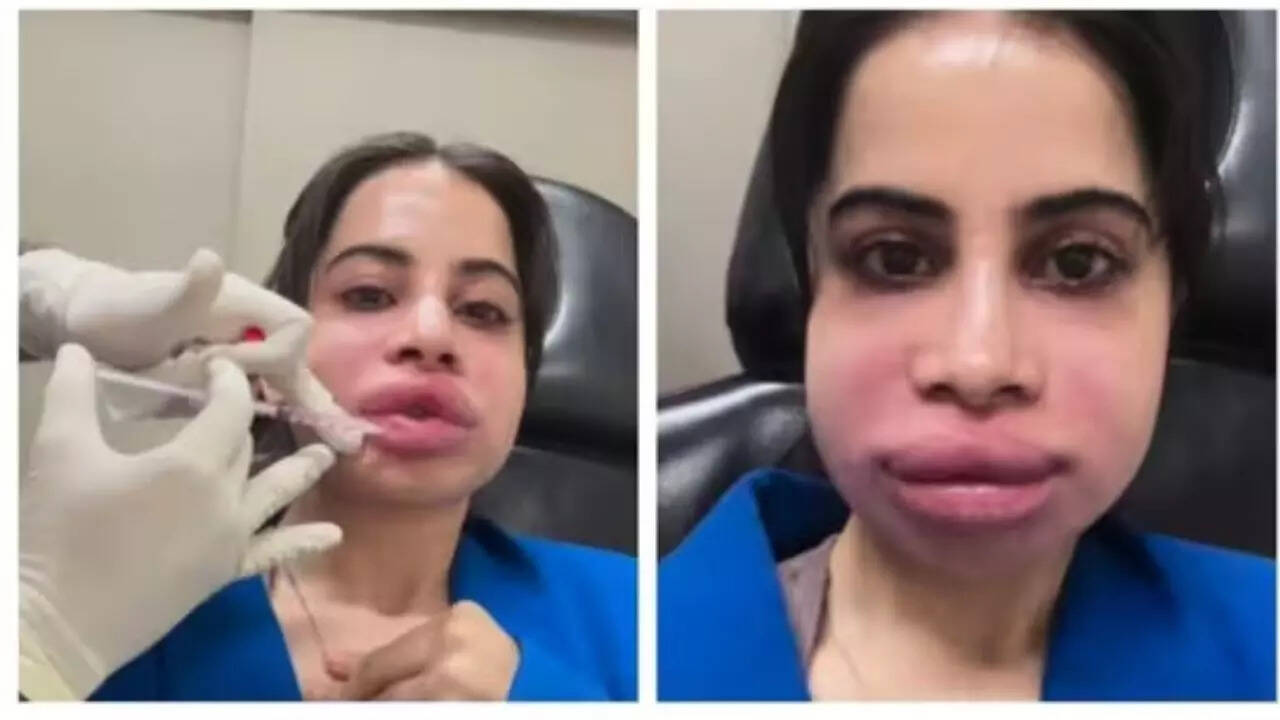 Uorfi Javed gets her lip fillers dissolved after 9 years, shares ...