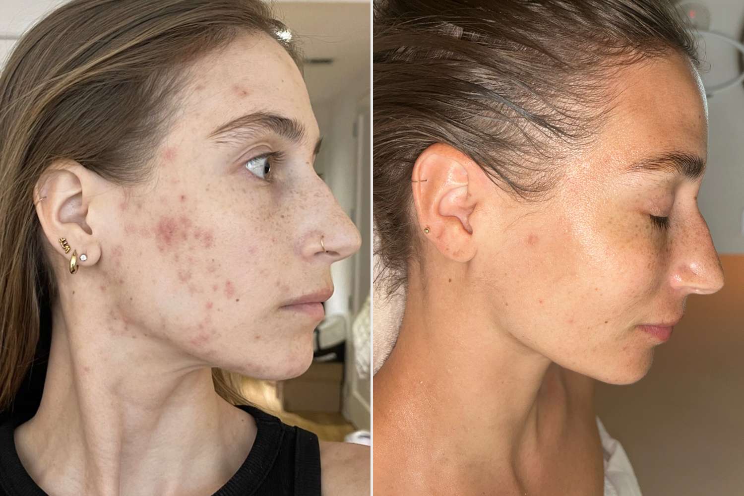 Amanda Batula Opens Up About Acne, Anxiety and the Clear Skin Method ...
