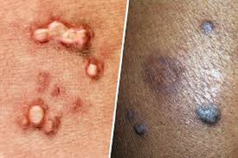 Why do warts appear on the body, when do they sound the alarm; know the ...