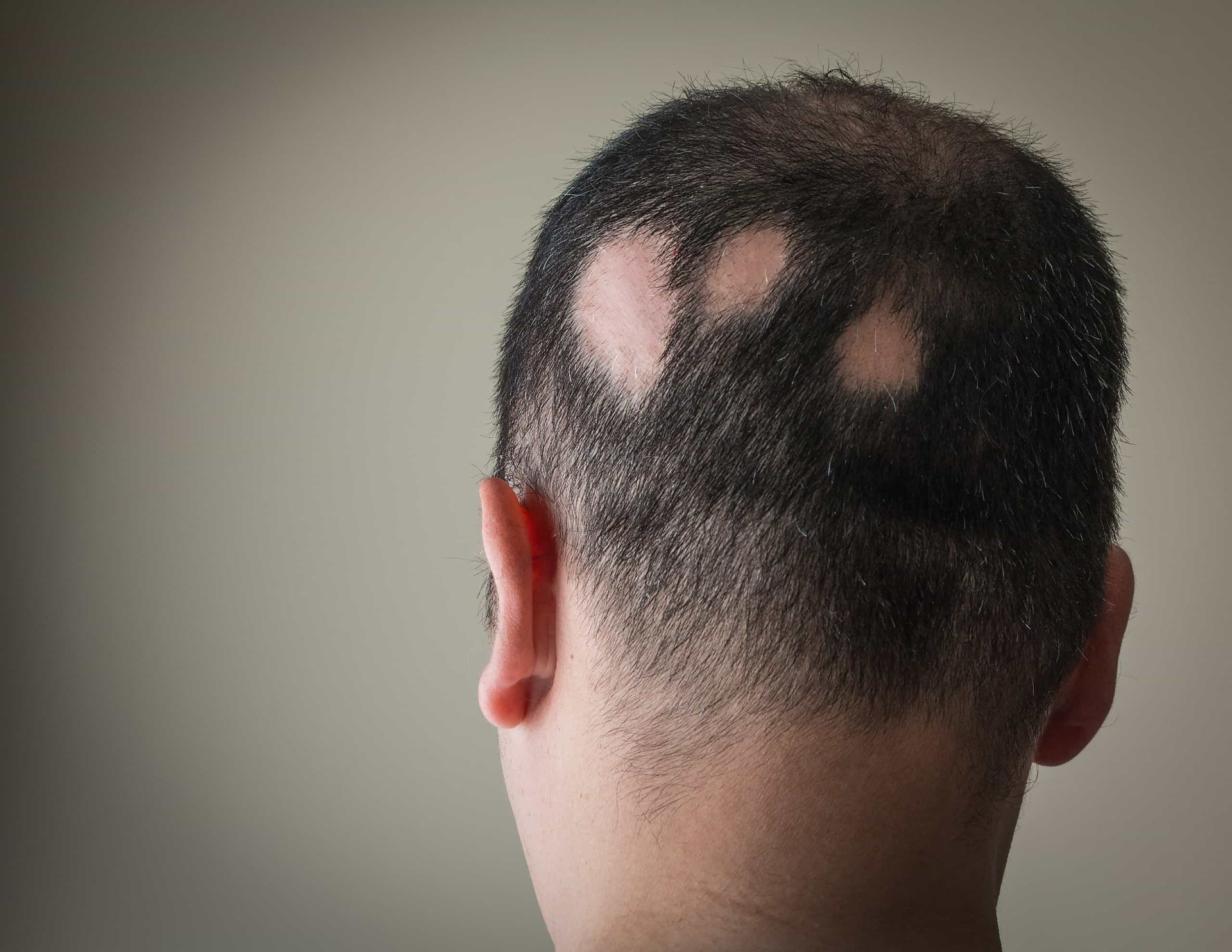 Alopecia and the celebs who've struggled with it
