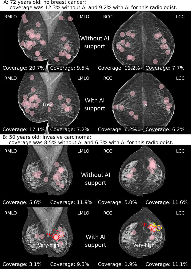 AI helps radiologists spot more lesions in mammograms