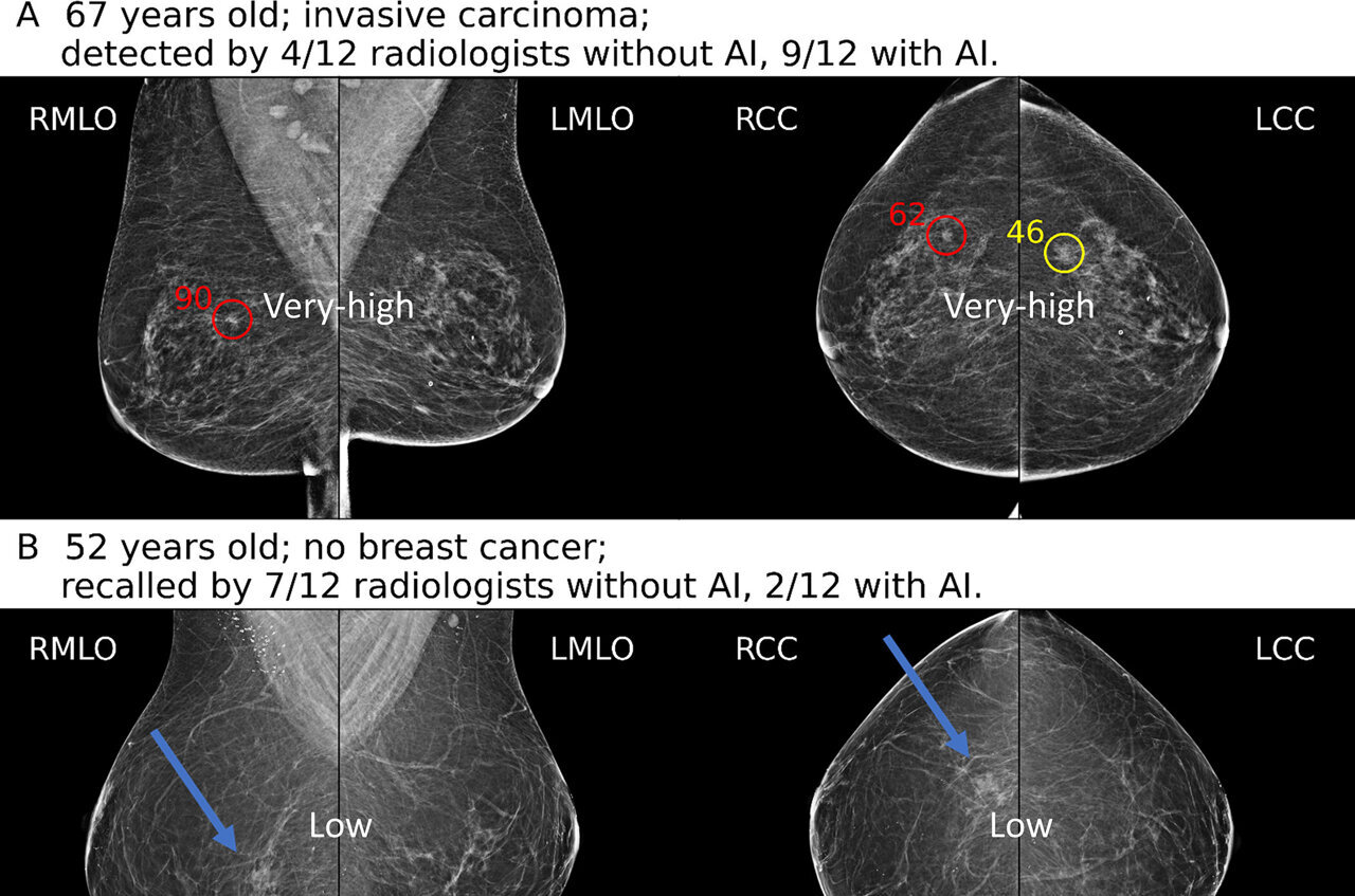 AI helps radiologists spot more lesions in mammograms