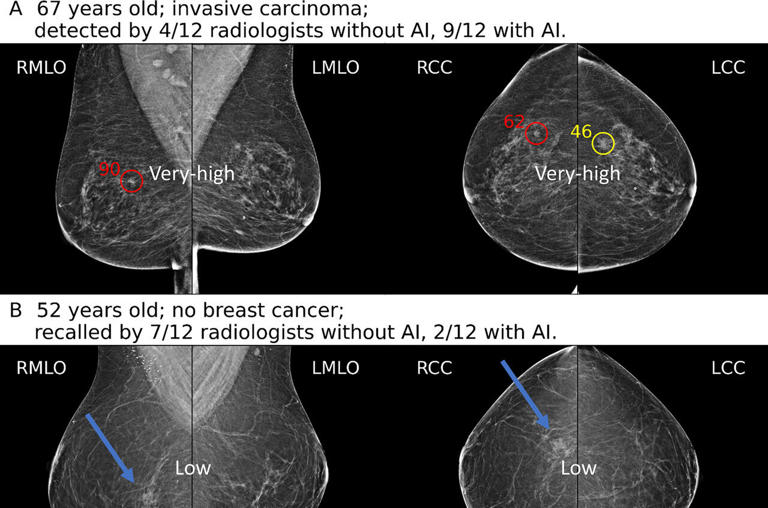 AI helps radiologists spot more lesions in mammograms
