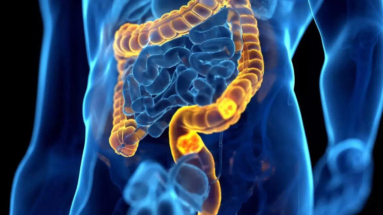 Colon cancer sees alarming rise in young adults; Scientists blame this ...