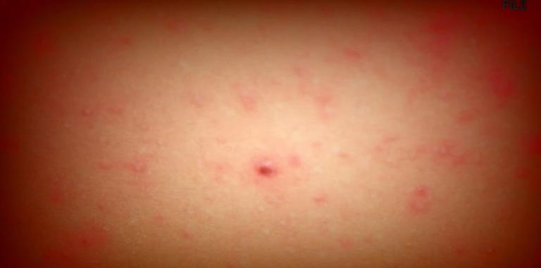 Health department confirms 1st SC measles case of the year