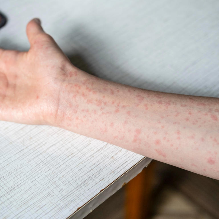 Measles cases in the U.S. break a 33-year record