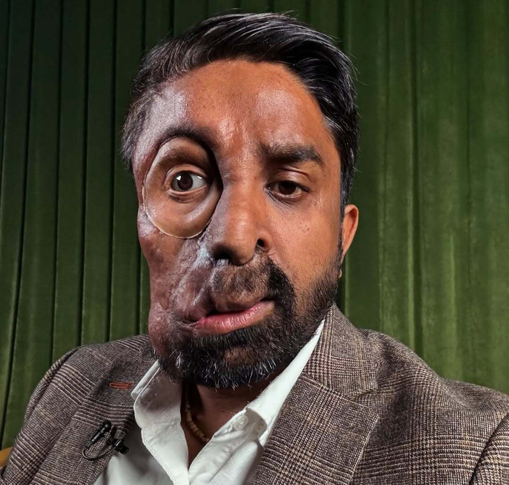 Man Denied Service at Café Due to Rare Condition, Sparking Heated ...