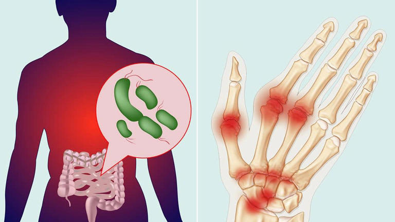 Scientists find major link between gut health and arthritis