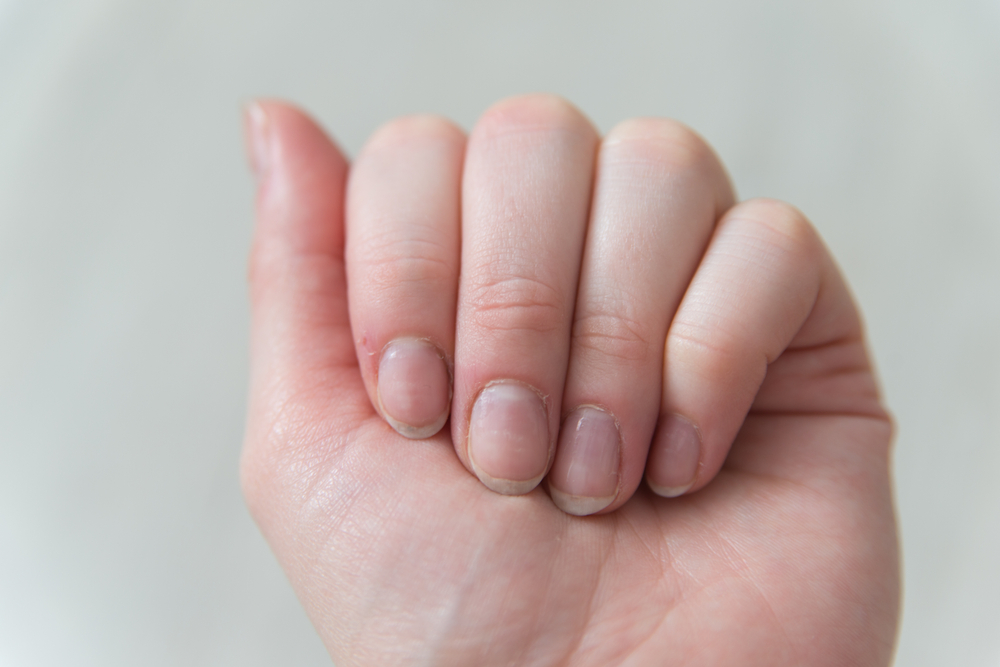 Nail Changes You Should Never Ignore – It Might Be Cancer