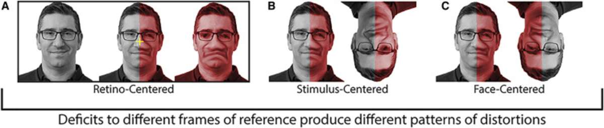 Only 80 People In The World Have 'Demon Face Syndrome' — It Makes Them ...