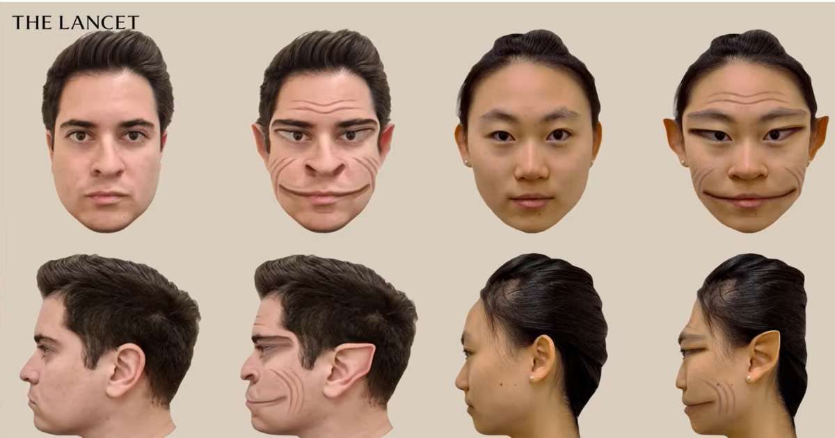 Only 80 People In The World Have 'Demon Face Syndrome' — It Makes Them ...