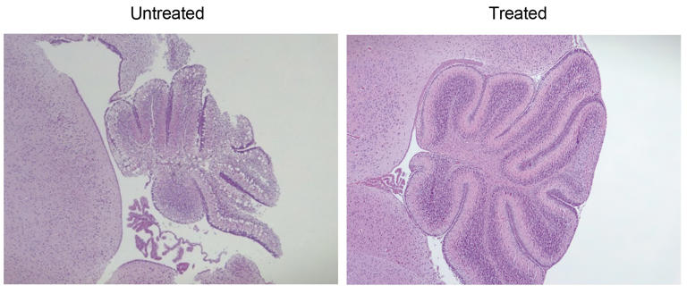 8-year-old with rare, fatal disease shows dramatic improvement on ...