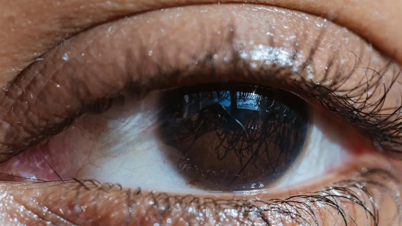 Eye-popping risks: what you should know about cosmetic eye colour surgery