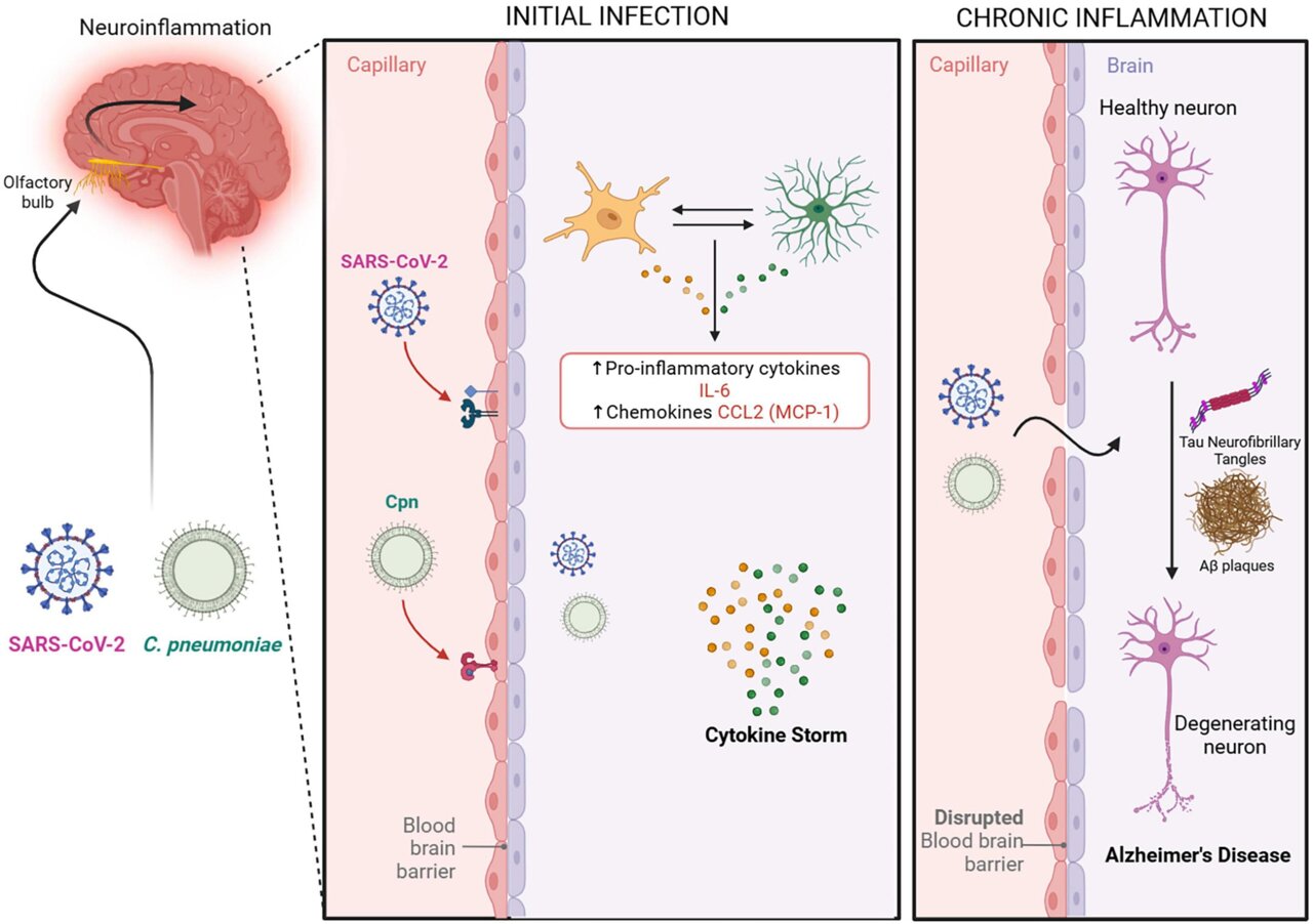 Study links COVID-19 and bacterial infection to Alzheimer's disease