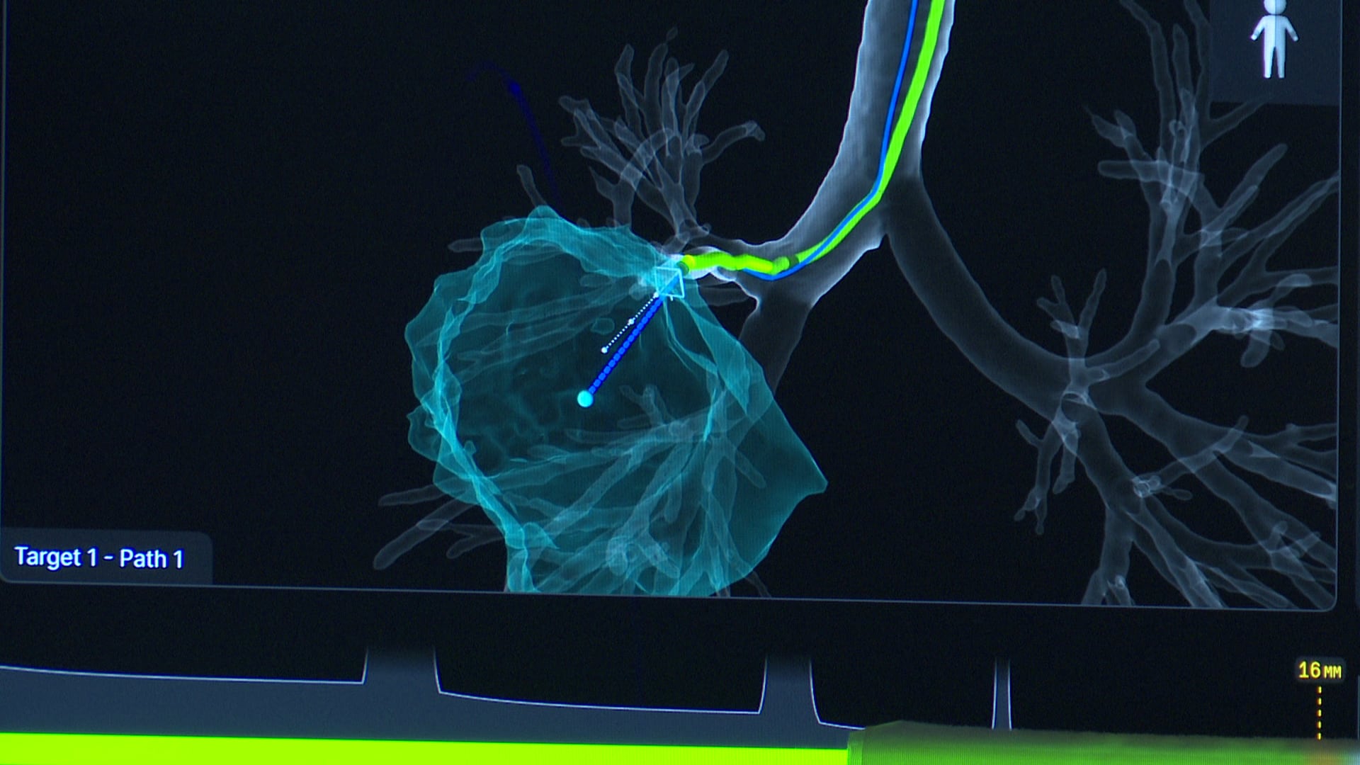 New robotic tool at University of Michigan Health-Sparrow helping ...