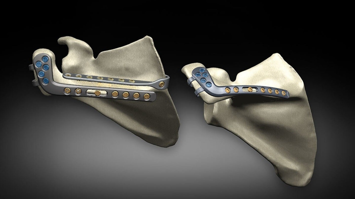 FDA grants 510(k) clearance for Exactech’s scapula reconstruction system