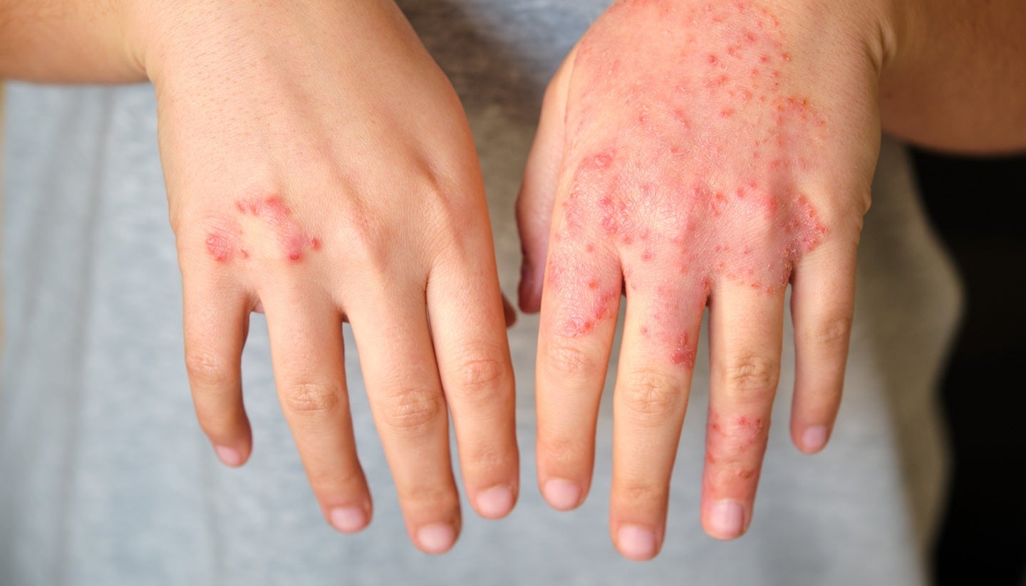 LEO Pharma reports results from interim analysis of Phase IIIb atopic ...