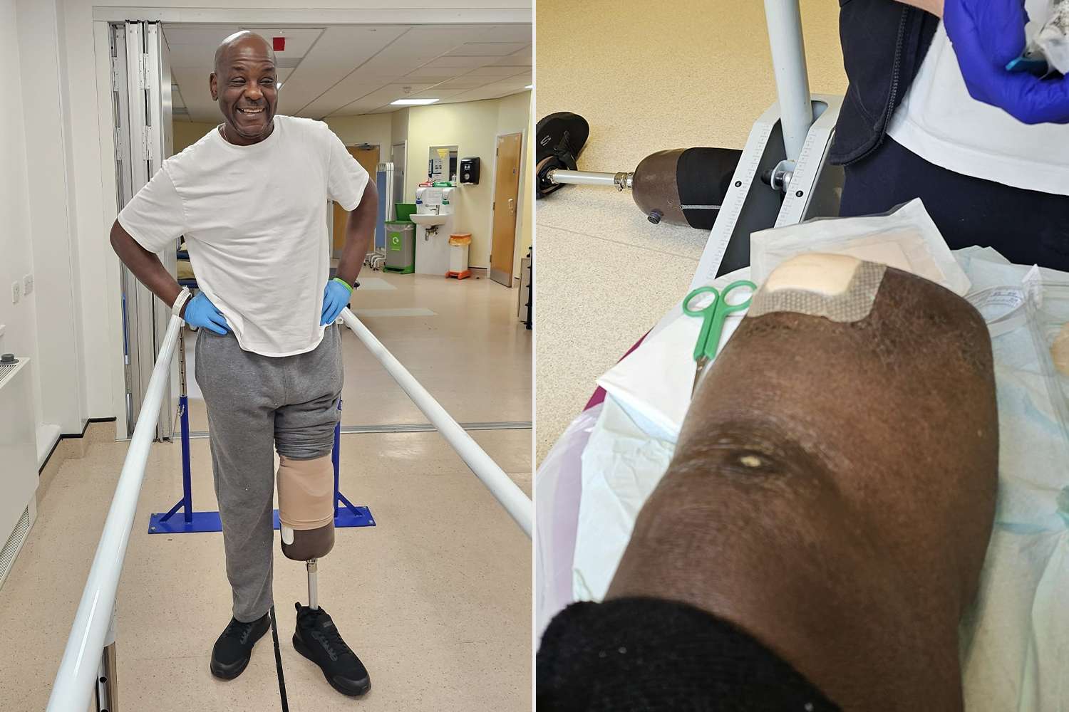 Man Needs Leg Amputated After Treating Burns from Home Pedicure