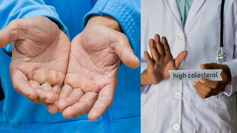 Check Your Hands for Signs of High Cholesterol, Warns Expert