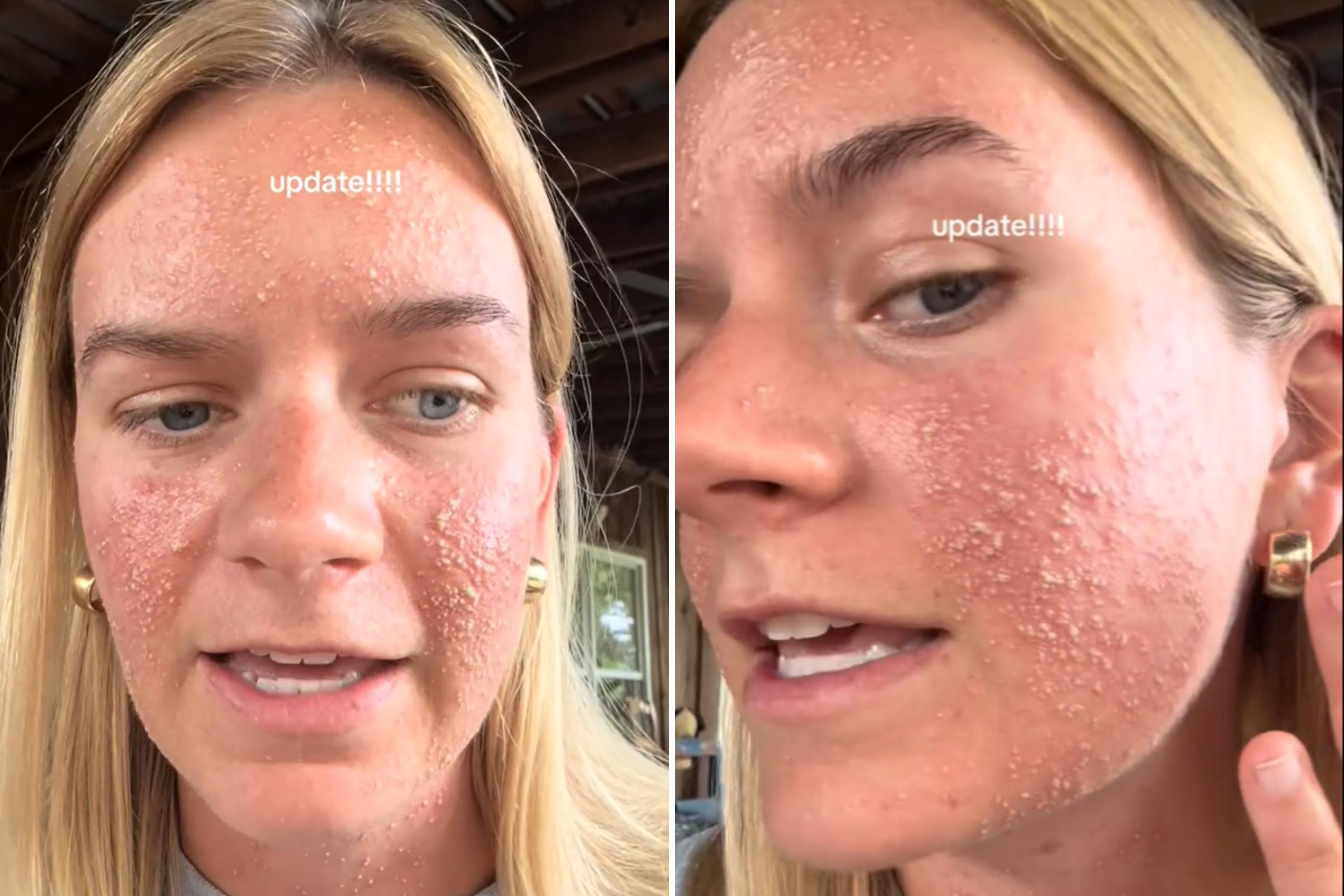 Woman gets bitten by spider, horror at what appears on face next day