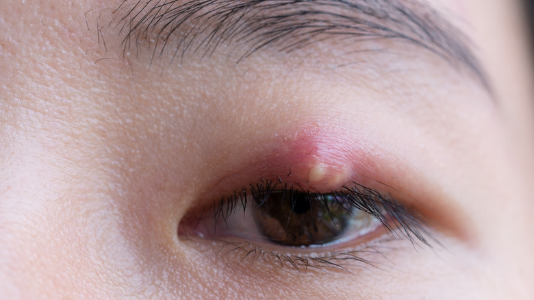 What It Really Means When The Corner Of Your Eye Hurts