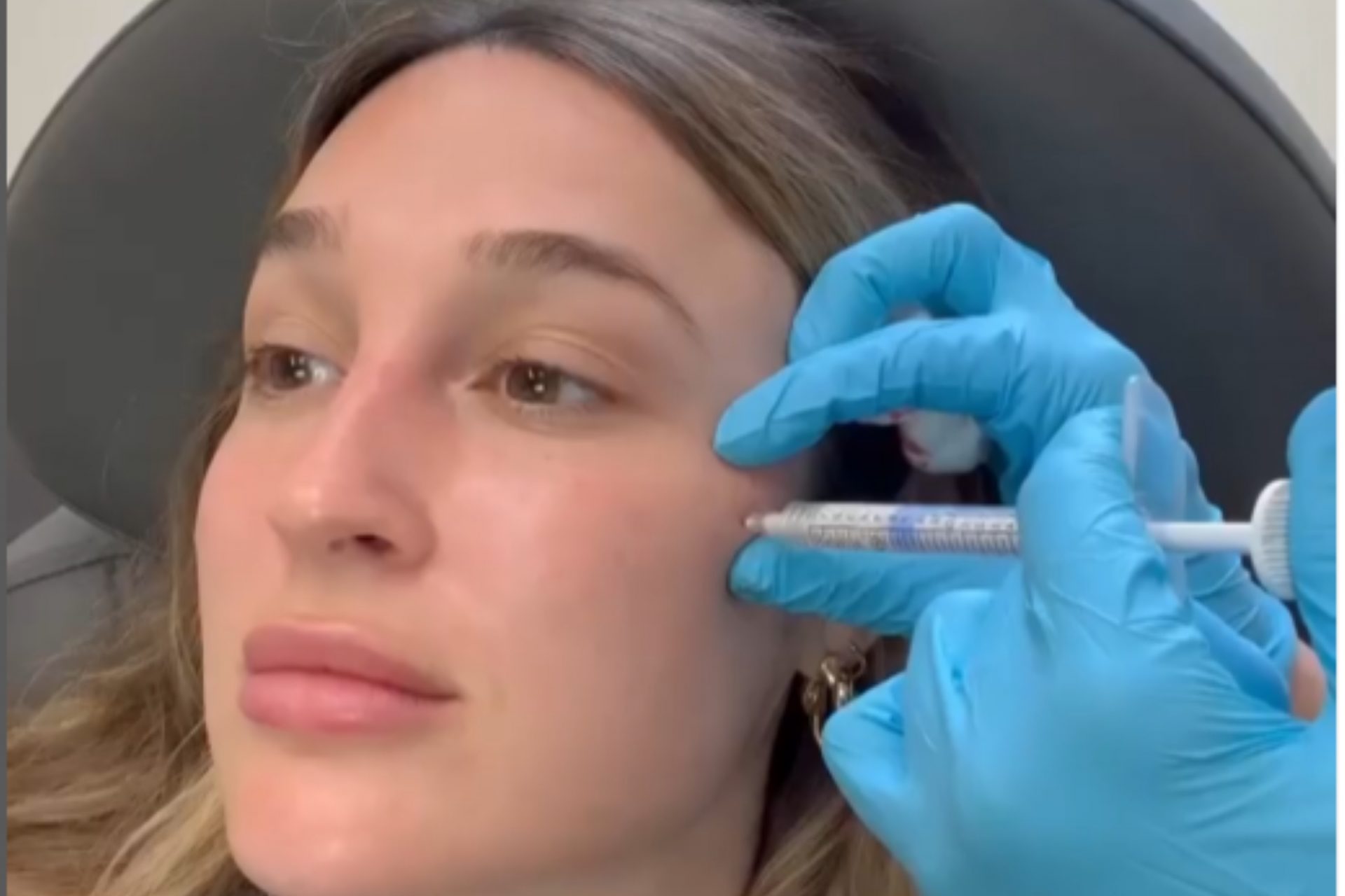 Bótox: todo lo que necesitas saber sobre el 'veneno milagroso' para tu ...