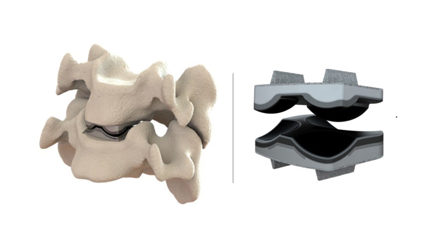 FDA approves Dymicron’s study of cervical artificial disc
