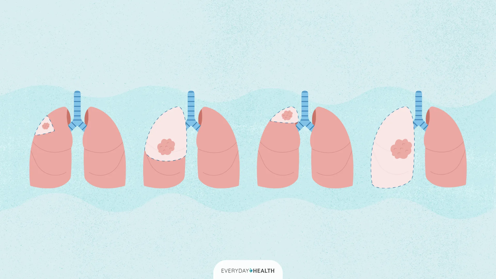 What Is Lung Cancer Surgery?