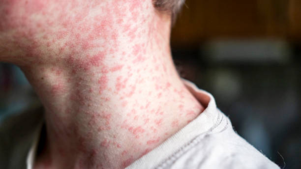 Measles isn’t over when the rash fades: 8 critical health problems that ...