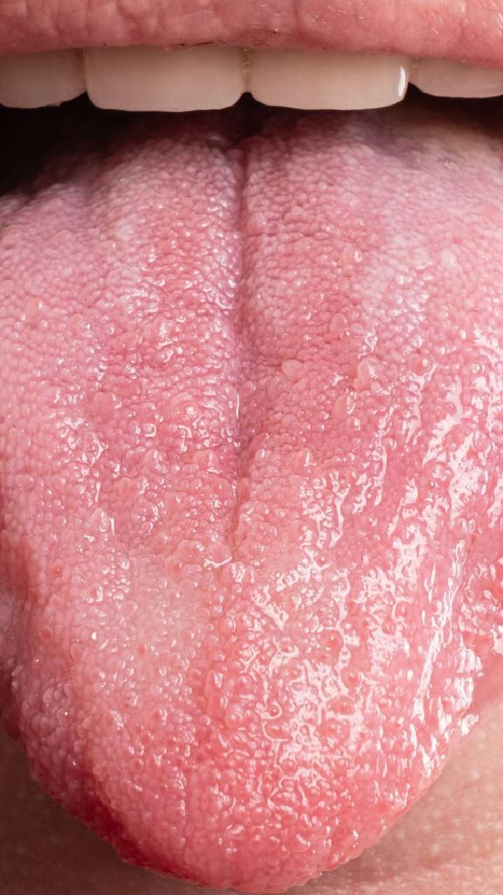 7 Early Signs Of Tongue Cancer You Shouldn’t Ignore!