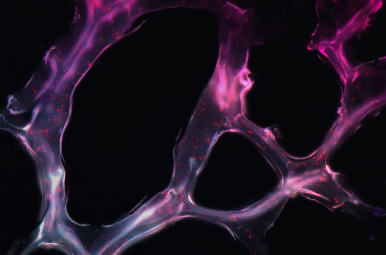 Targeted radiation offers promise in patients with metastasized small ...