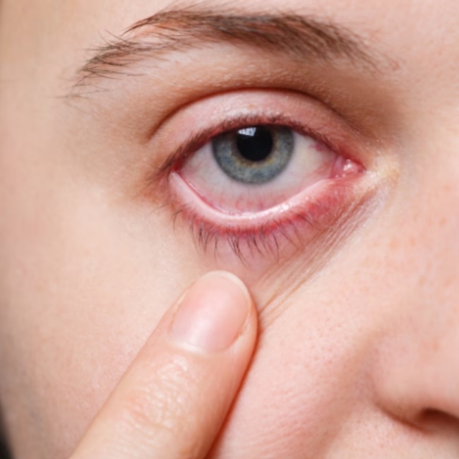 7 common eye issues that indicate you are not sleeping enough