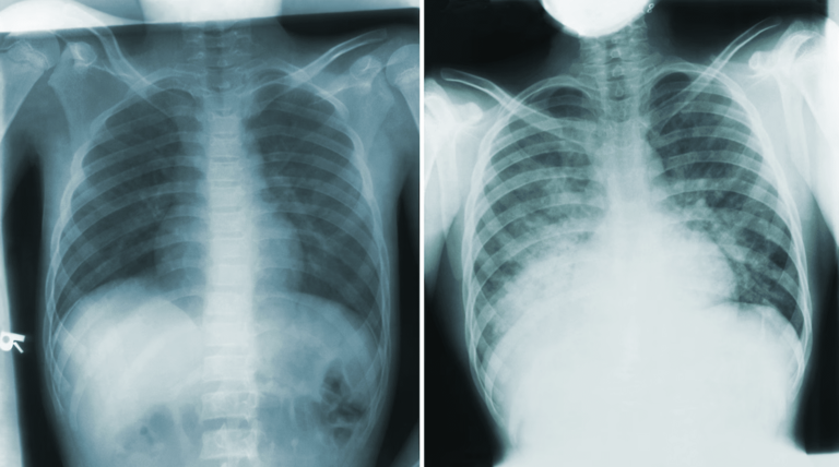 What Arizona's Pneumonic Plague death means for public health