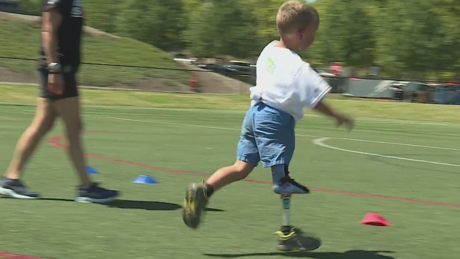 Foundation gives local kids fitted prosthetic limbs