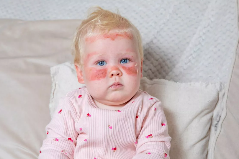 Scots baby left with 'severe burns' despite wearing factor 50 sun cream ...