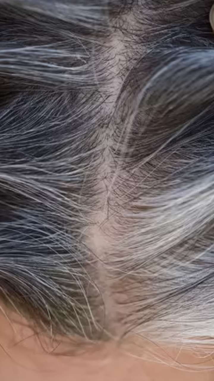 Does Pulling One White Hair Cause More to Grow?