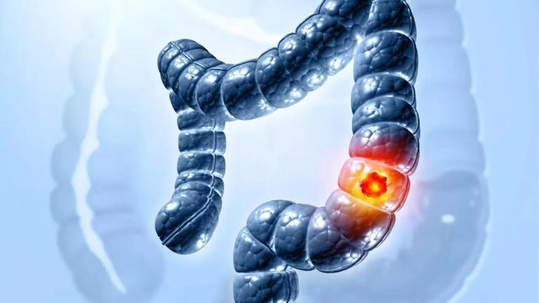 Colon cancer rising among youngsters: Top US doc alerts about 5 warning ...