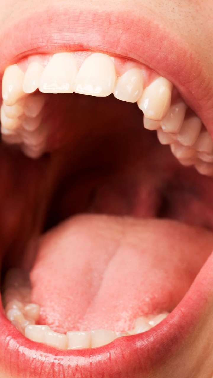 5 Side Effects Of Teeth Whitening Strips On Oral Health