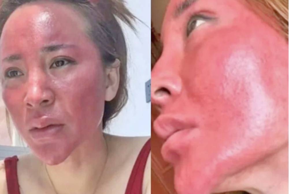 Woman's face severely swells, infected after skipping proper makeup ...