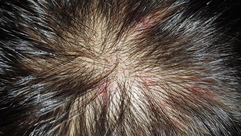 Here's What It Means If You Have Bumps on Your Scalp