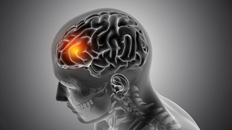 Can You Prevent A Stroke? Here's What Doctor Suggests