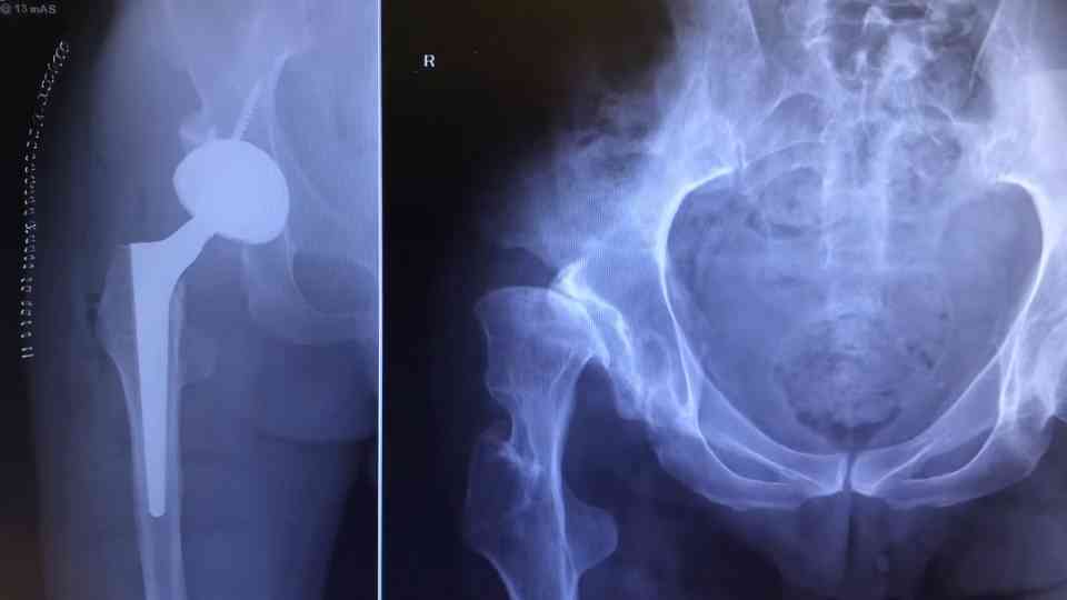 Hip Dysplasia And Developmental Delay