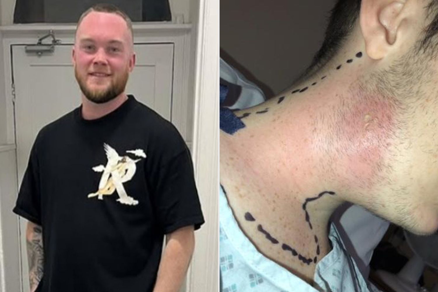 Man Hospitalized with Deadly Sepsis After Popping a Pimple on His Neck ...