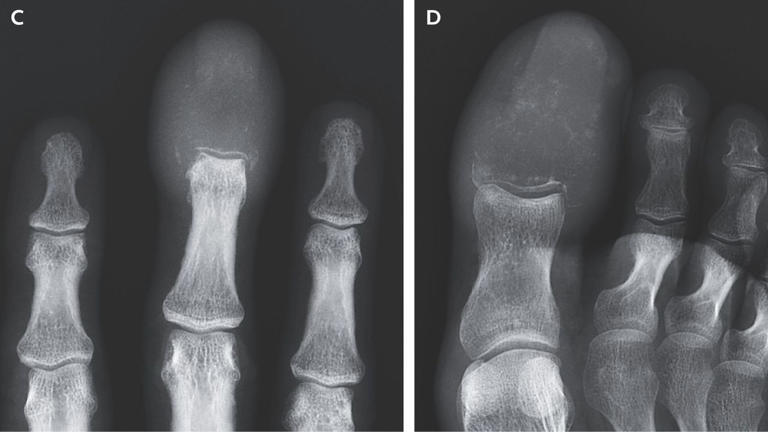 Weird swelling of man's fingers and toes revealed cancer had ...