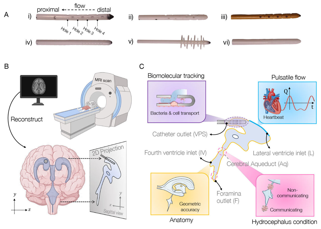 Designing better brain shunts: Fluid dynamics model could help ...