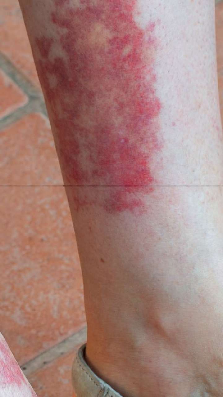 What Is Disney Rash? Check Signs And Symptoms!