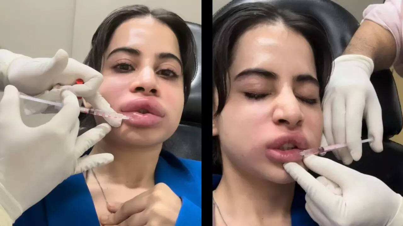 Lip fillers gone wrong or normal side effect? Expert breaks down Uorfi ...